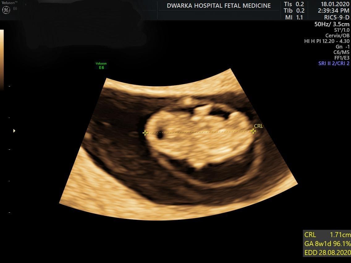 First Trimester Ultrasound - narikaa.com